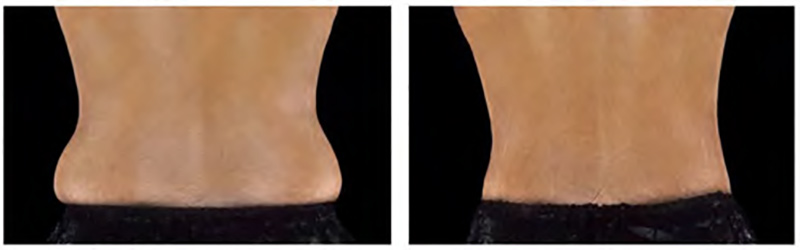 The Complete Guide to EMSCULPT NEO | Slim Studio Atlanta | Blog