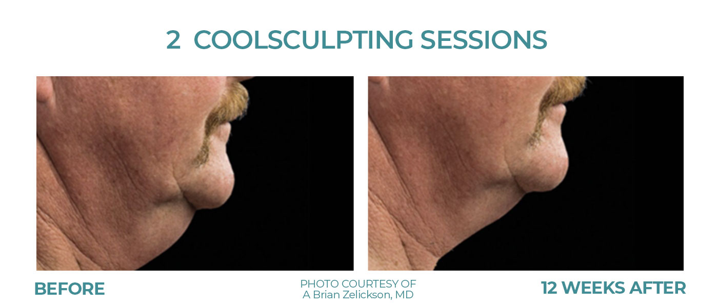 Body Sculpting Before & After Photos in Atlanta | Slim Studio